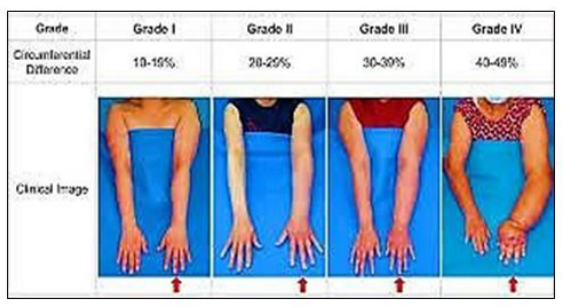 Table 2: Upper extremities (Cheng grading)