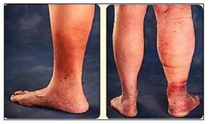 Figure 2: Long standing deep venous insufficiency can lead to a ...