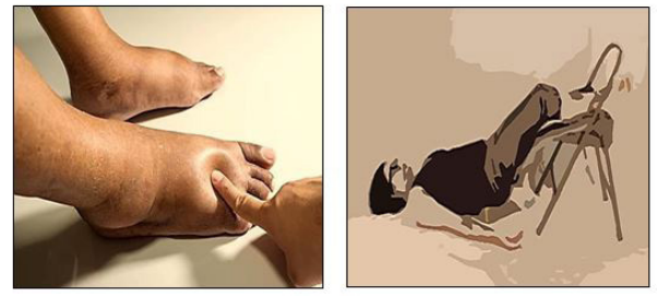 Figure 3: Assessment techniques for lymphedema